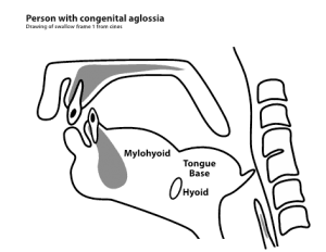 Swallow studies in congenital aglossia - Dysphagia Cafe