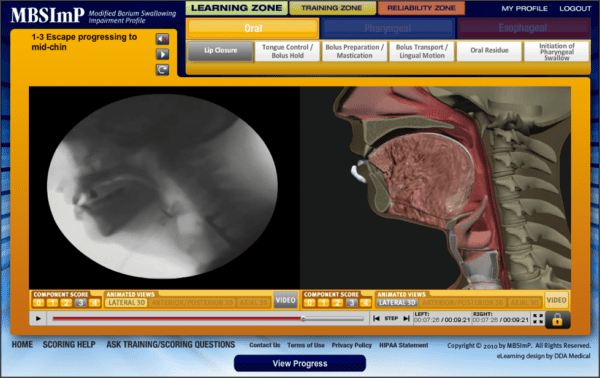 Modified Barium Swallow Impairment Profile© | Dysphagia Cafe