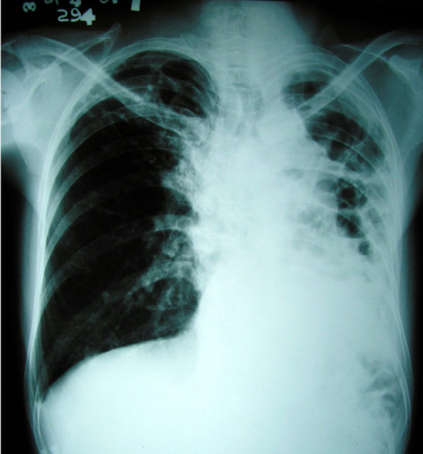 Cough dysfunction in the management of patients with dysphagia ...